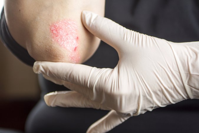 Psoriasis Flare-Ups Tips (Part 2) - Dr Susan Jamieson